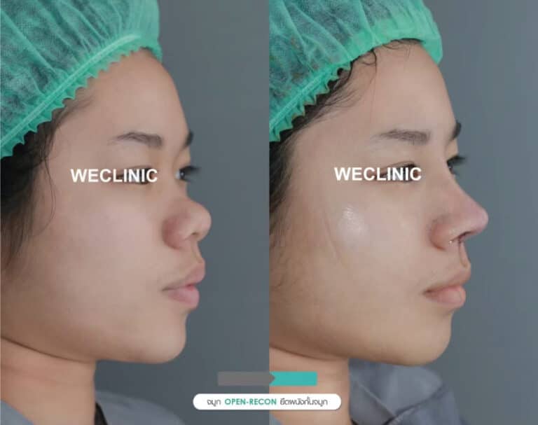 How to Fix a Wide Nose: Causes & Best Solutions