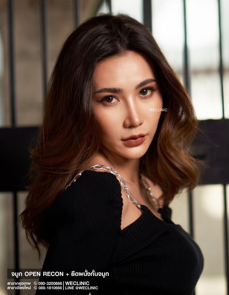 ไขข้อสงสัย! เสริมจมูกอยู่ได้กี่ปี ซิลิโคนมีอายุกี่ปี ต้องเปลี่ยนไหม